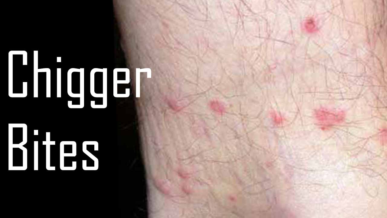 Chigger Rash Pictures